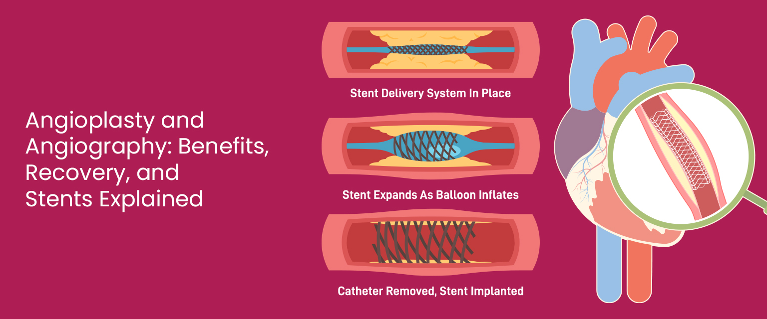 A Deep Dive into Angioplasty, Angiography and Life After