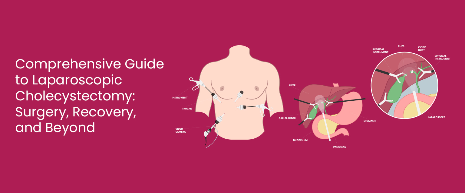 Laparoscopic Cholecystectomy: Surgery, Benefits & Recovery