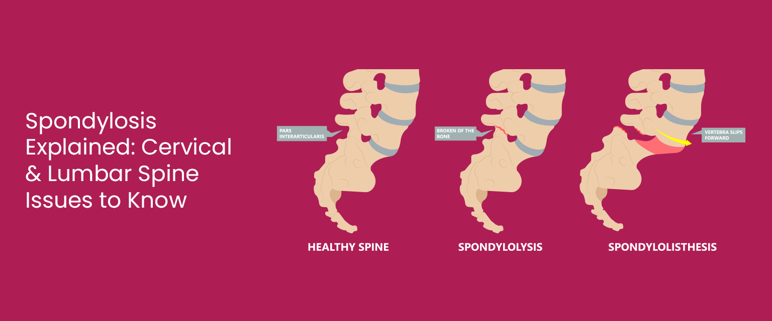 Spondylosis Symptoms Causes Treatment And Rehabilitation